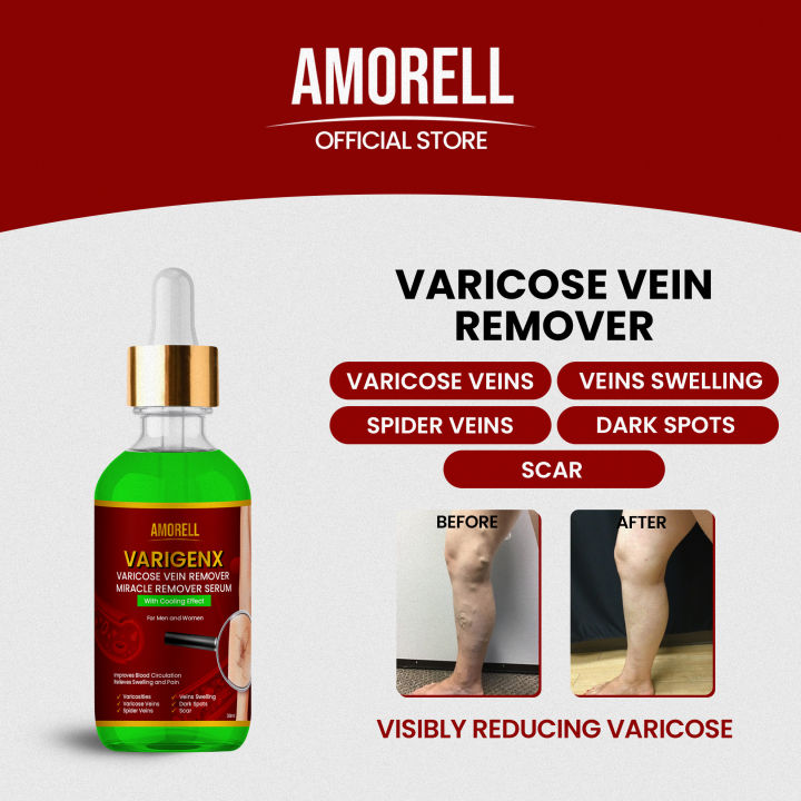 AMORELL VARIGENX VARICOSE SERUM 30ml, Spider Vein, Effective Varicose ...