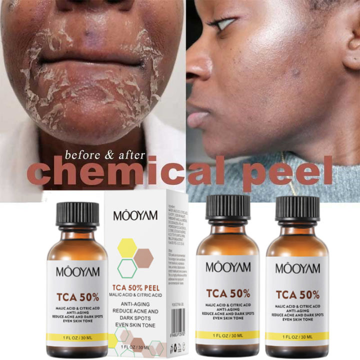 【Expert Recommended】 Tca 50% Chemical Peel Tca Peel Acid Skin ...