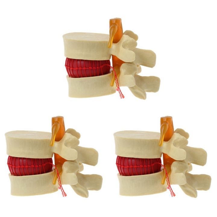 3X Lumbar Vertebrae Model Anatomical Spine Lumbar Disc Herniation ...