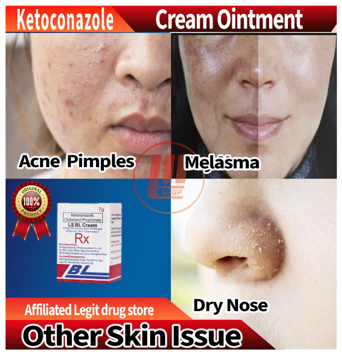 Cream For Acne \ An-an \ Buni \ Skin Dry issues \ Melasma (Authentic ...