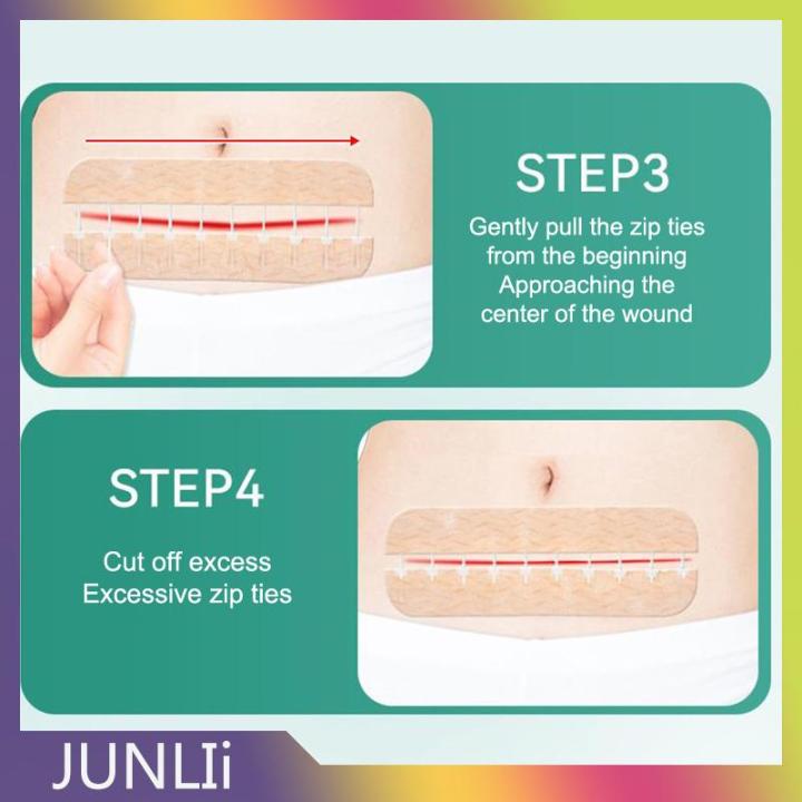 JUNLIi Band-Aid Zipper Tie Wound Closure Patch Hemostatic Patch Wound ...