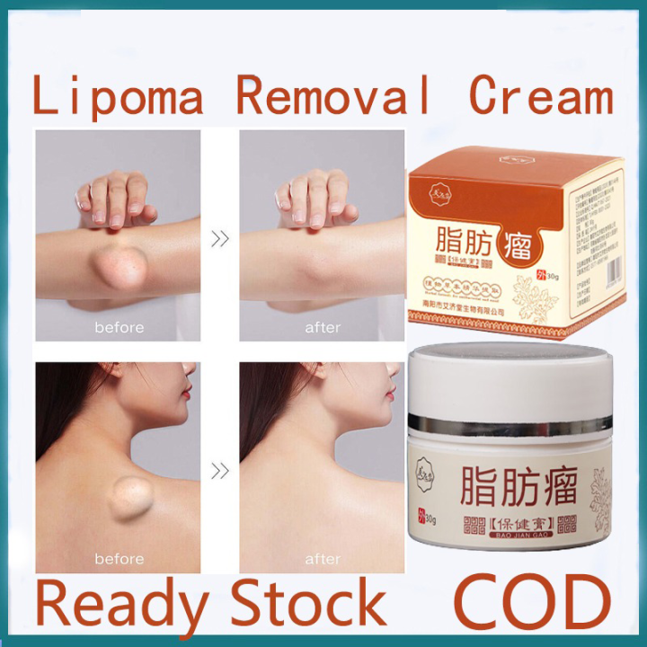 【Original】Lipoma Removal Cream Original subcutaneous Lipoma Elimination ...