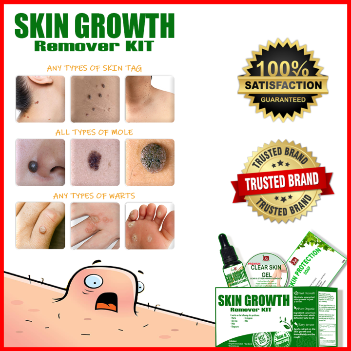 100% EFFECTIVE Skin Growth Remover KIT painless mole remover , nunal ...
