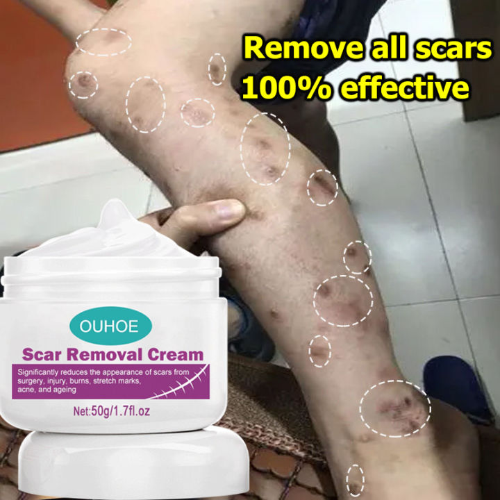 fix scar removal original scar gel scars remover for old scars legs ...