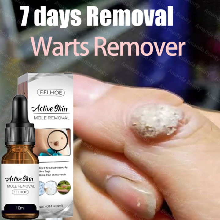 Warts Remover Pure Kasoy Oil Warts Remover Tags Mole Nunal Kulugo Warts ...