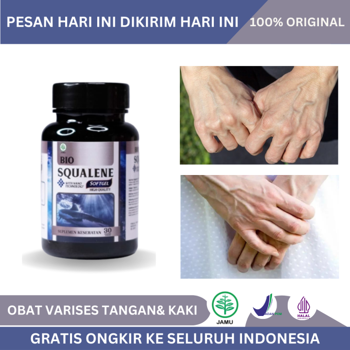 Obat Varises Di Tangan & Kaki, Obat Urat Menonjol, Obat Varises Di ...