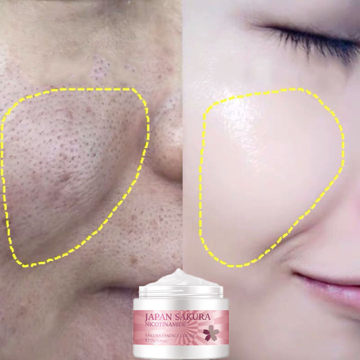 🔥BEST SELLER JAPAN Sakura Cream F or All skin types Acne Care ...