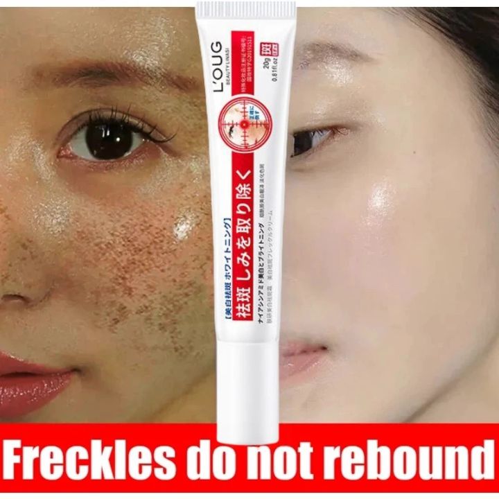 Whitening Freckle Cream Remove Dark Spots Anti Freckle Cream ...