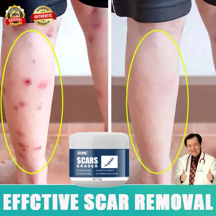 scars remover for old scars fix scar removal original peklat remover ...