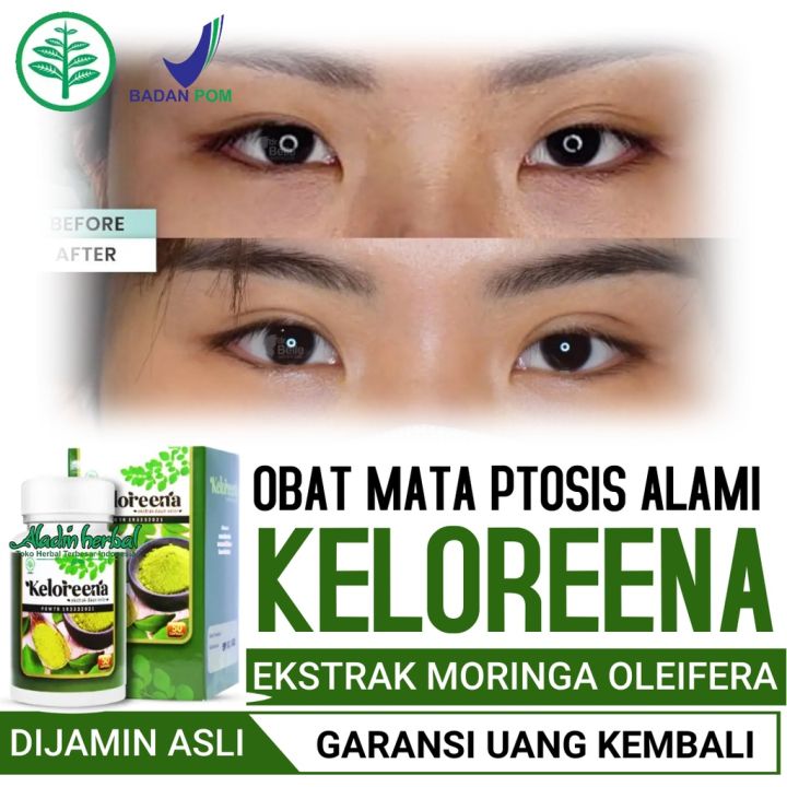 Obat Mata Ptosis Beda Sebelah - Mata Floaters, Pterigium KELOREENA ...