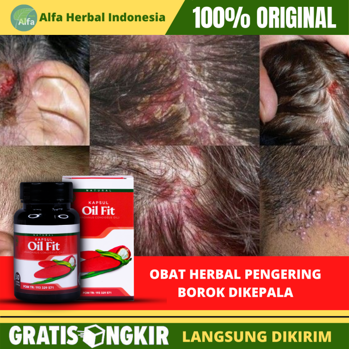 Obat Koreng Dikepala - Borok Dikepala - Kepala Berair Bau - Kepala ...