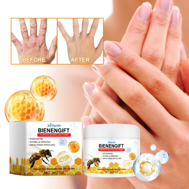 Ximoon 30g/box Bee Venom Psoriasis Treatment Cream Skin Eczema ...