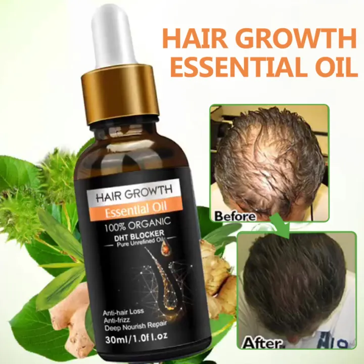 Hair Growth Essential Oil Biotin Cold-Pressed DHT Blocker และ Hair ...