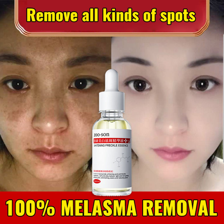 Niacinamide anti melasma serum melasma remover from japan/ The United ...