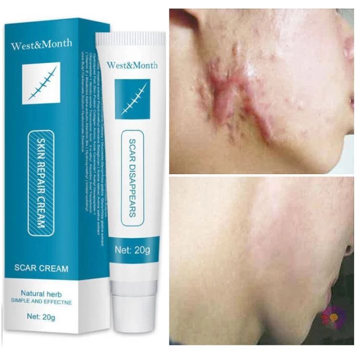 WOOLOVE Herbal Scar Removal Cream Gel Stretch Marks Remove Acne Spots Burn Surgical Scars ...
