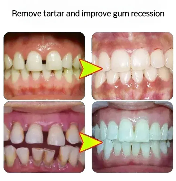 Whitening and Strengthening Probiotic Toothpaste Peculiar Smell Removal ...