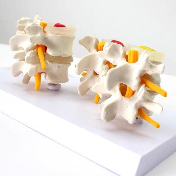 Normal medical lumbar spine lesions combination model of intervertebral ...