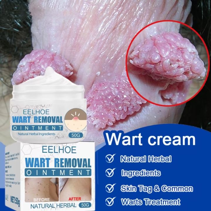Warts Remover Original Cream 50g Warts Magic Remover Wartz Removal ...