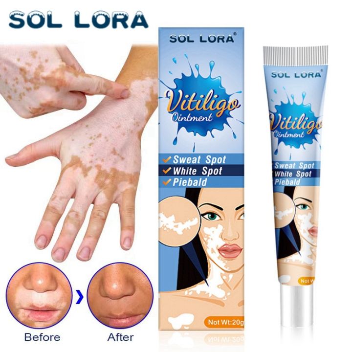 SOL LORA花斑护理保健膏 SOL LORA Spotted Care Cream | Lazada