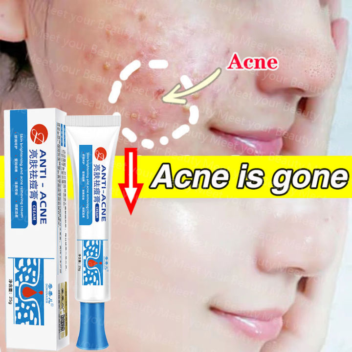 30g Acne Scars Remover for Face Pimples Acne Remover Scar Gel Pimple Quickly Pimple Marks ...