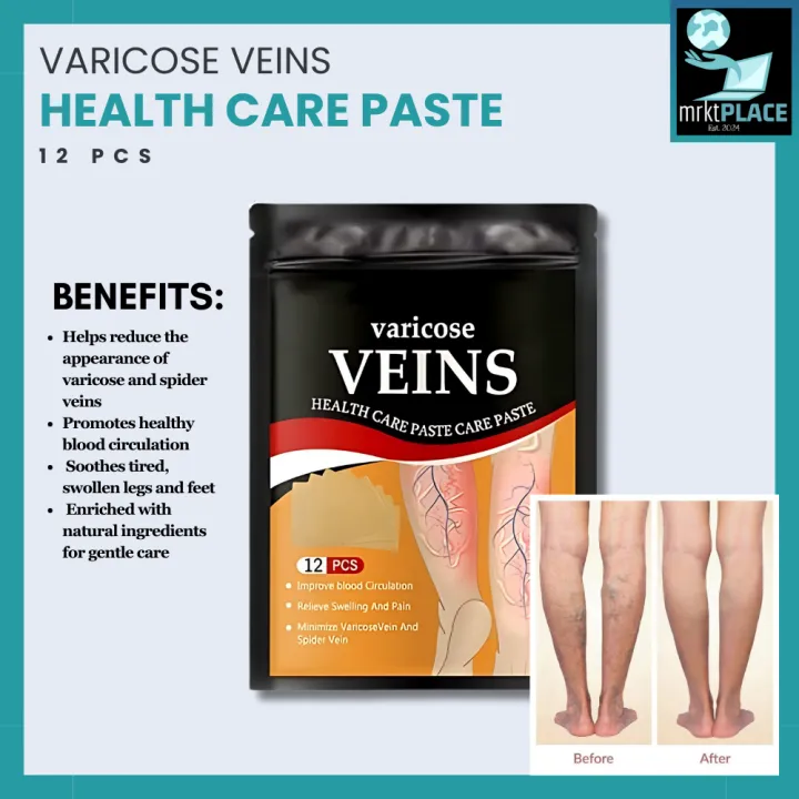 Varicose Vein Remover Patch Effective Pain Relief Varicose Veins ...