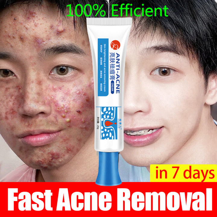 Original Remove Pimples Quickly Pimple Remover Acne Cream Fades Acne Marks Repairs Acne Pits ...