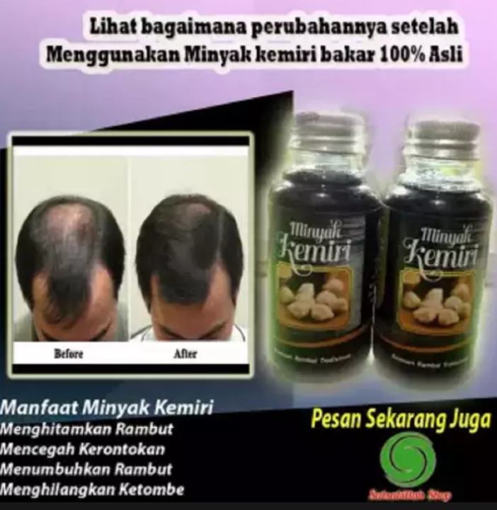 MINYAK KEMIRI PENUMBUH RAMBUT BOTAK RONTOK OBAT PENYUBUR RAMBUT OBAT ...