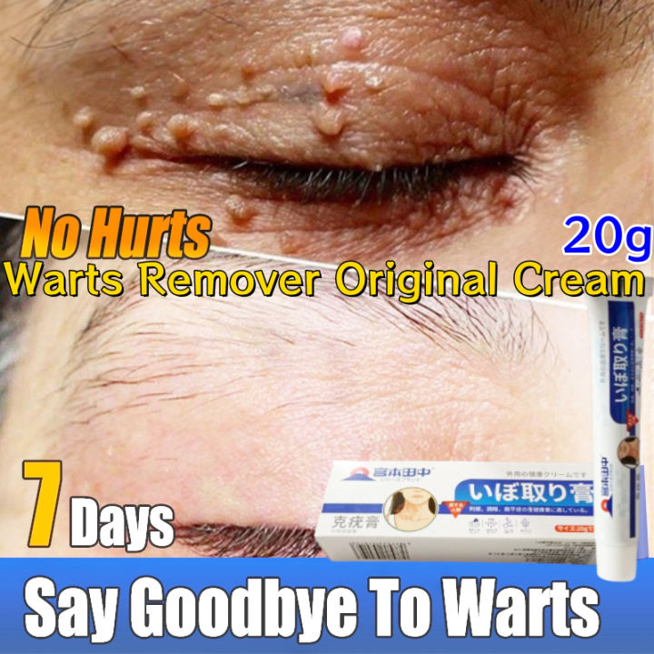 20G Warts Remover Original Watson warts removal kasoy oil warts remover ...