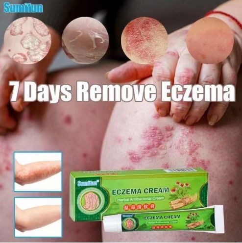 [Original] Eczema Treatment Cream gamot sa kati kati sa balat buni ...