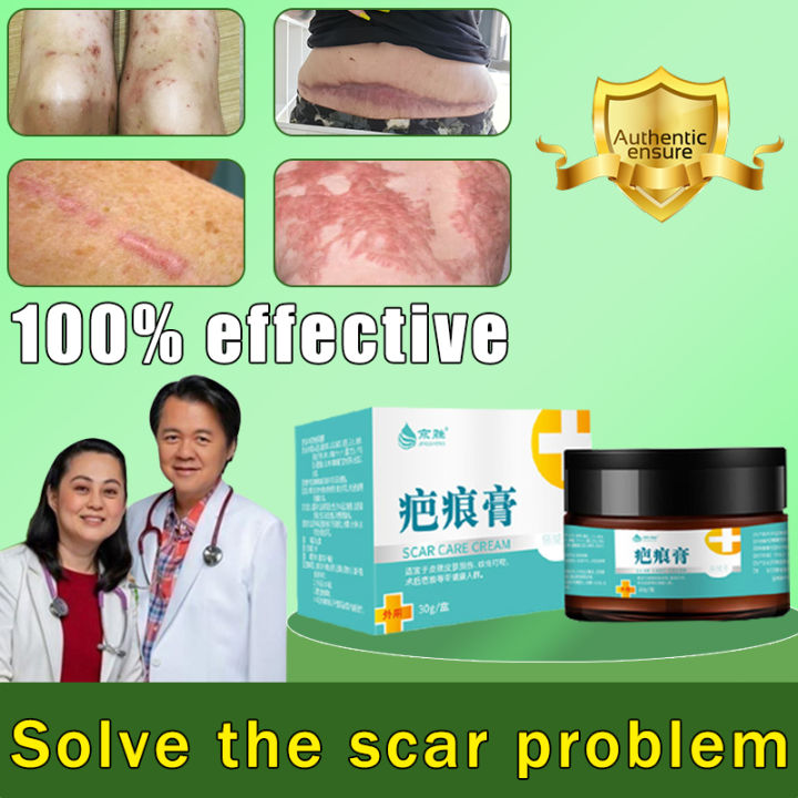 100% effective Scar Remover Cream 30g Remover Cream for Old Scars ...