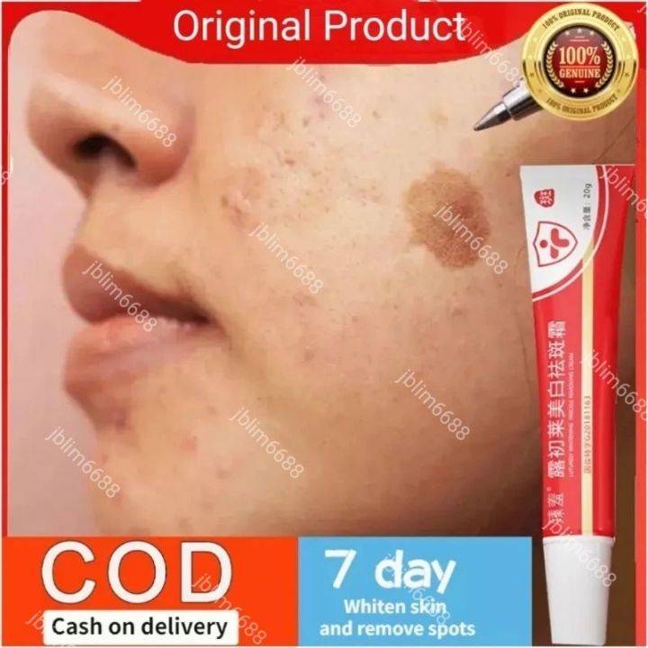 Whitening Freckle Remover Cream/Krim jeragat 祛斑霜 Pigmentation Remover ...
