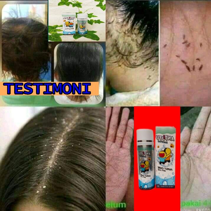 Shampoo Anti Ketombe Gatal Dan Kutu | Lazada Indonesia
