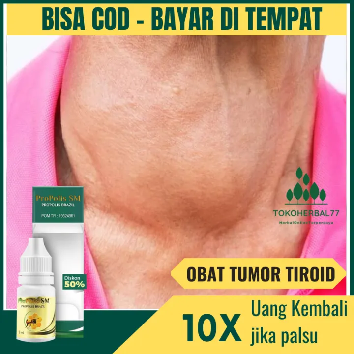 Propolis SM - Obat Tumor Tiroid, Obat Herbal Kelenjar Tiroid, Obat ...