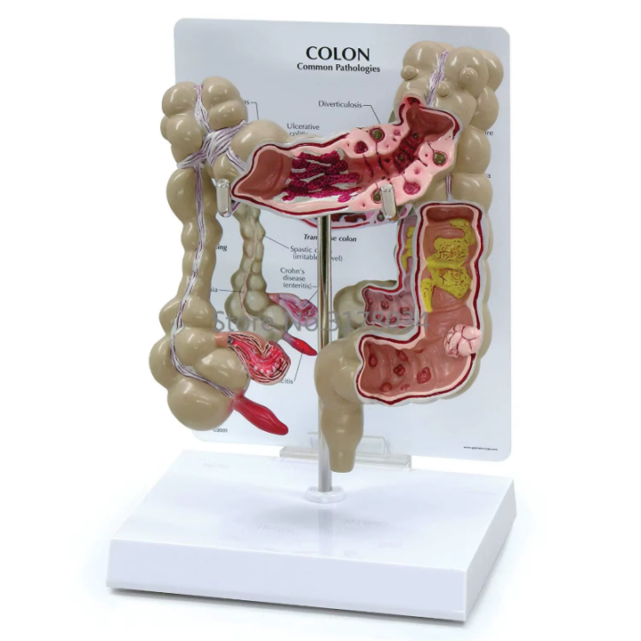 Colon Model Human Body Anatomy Replica of Colon w/Common Pathologies ...