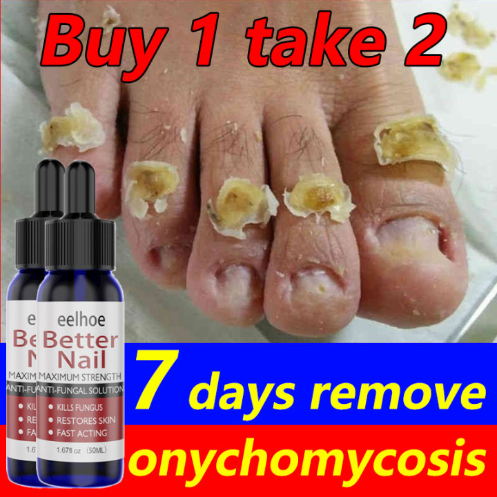 Buy 1 take 2 onychomycosis Eelhoe Nail repair treatment cream 50ml Nail ...