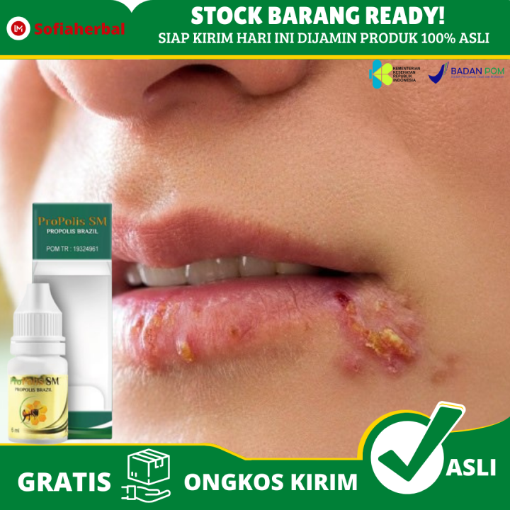 Obat Herpes Bibir, Bintik Bintik Putih Di Bibir, Luka Melepuh Sekitar ...