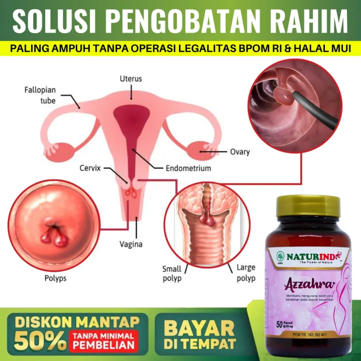 Obat Polip Rahim Paling Ampuh, Polip Dinding Rahim, Benjolan Pada ...