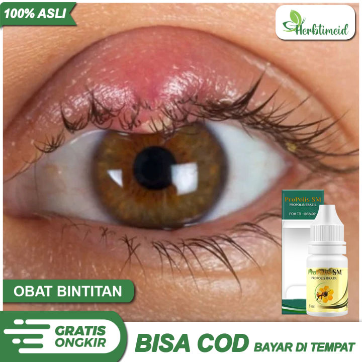 Obat Bintitan Kelopak Mata Bengkak Membesar - Obat Oles Kalazion di ...