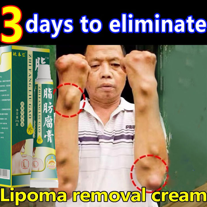 100 Effective Lipoma Removal Cream Treat Tumor Skin Swelling Ointment Herbal Cream Ointment