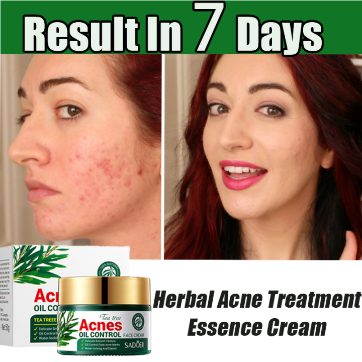 Pimples Remover Effective 50g Refreshing Anti Acne Cream Controls Acne ...