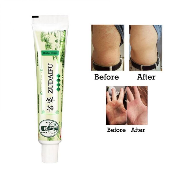 Natural Chinese Herbal Medicine Cream Eczema Dermatitis Psoriasis ...