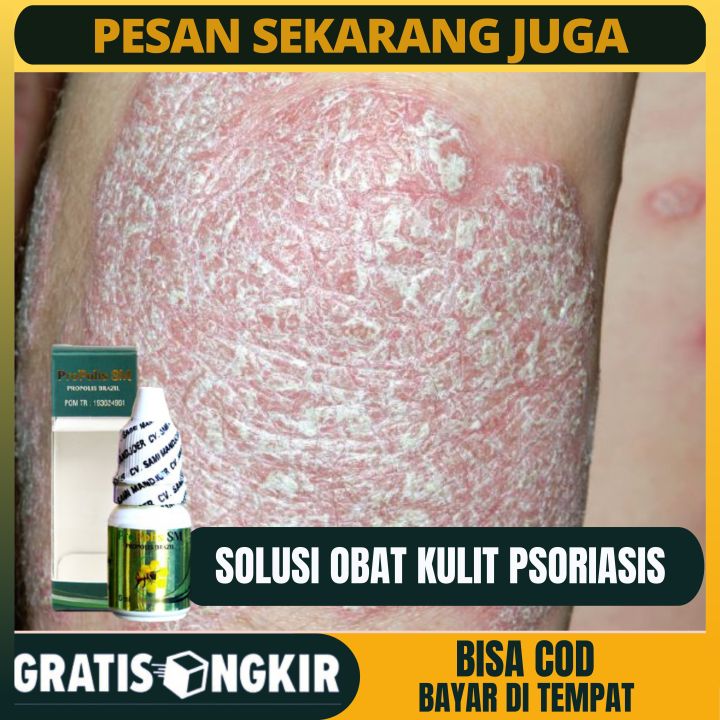 Solusi Obat Kulit Psoriasis Kering di Lutut Siku Sikut Kulit Bersisik ...
