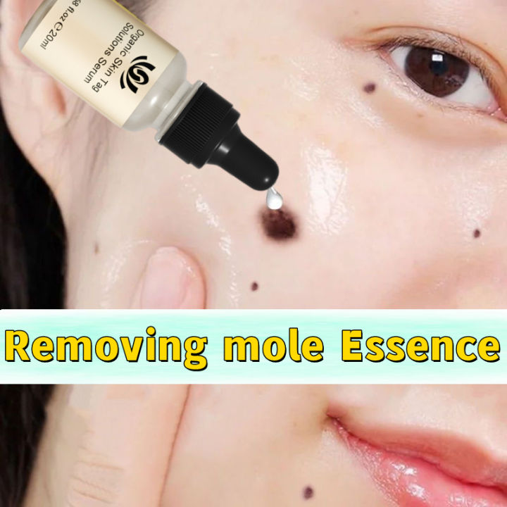 ready stock buang tahi lalat mole remover tahi lalat remover wart mole ...