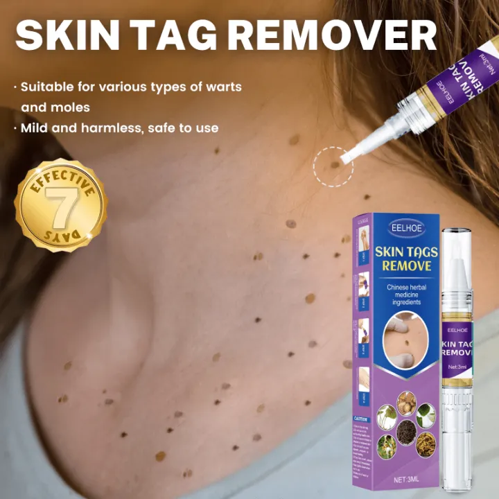Wart Removal Warts Remover Original Cream Wart Removal Liquid Pen Hand ...