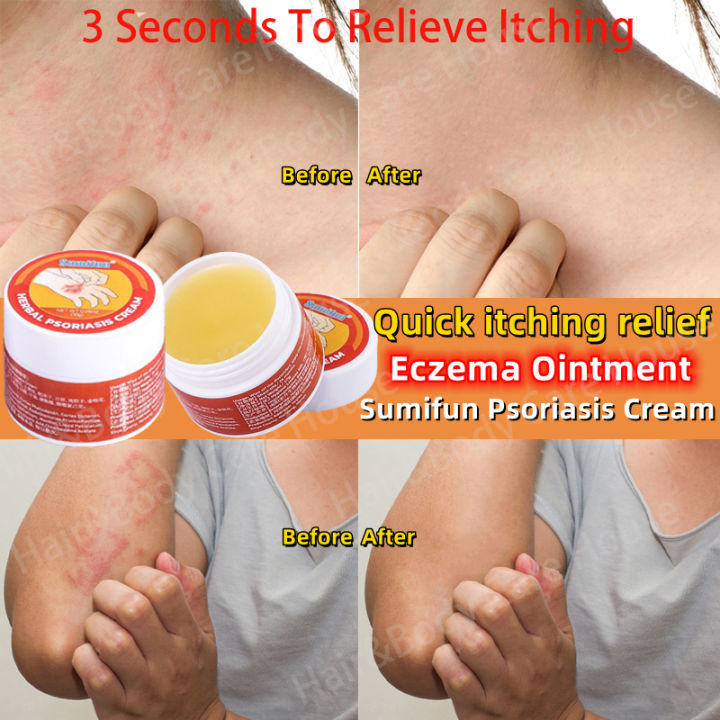 Sumifun Skin Disease Ointment Original Eczema Cream Antibacterial Cream ...