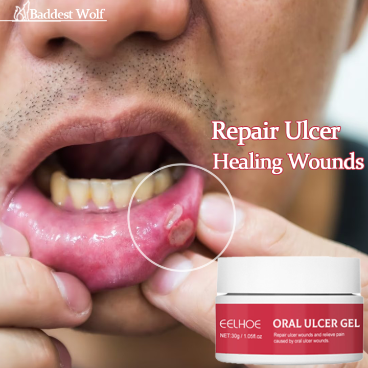 canker mouth sore gel 30g treatment mouth sore ointment mouth ulcer ...