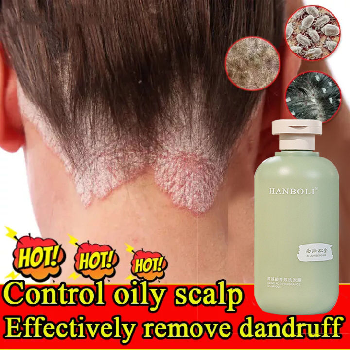 Anti Dandruff shampoo, Dandruff Remover, Anti Fungal, Anti Itchy Japan ...