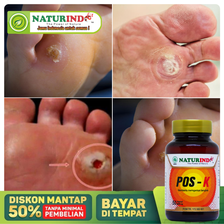 Obat Mata Ikan Paling Ampuh, Mata Ikan di Telapak kaki Dan Tangan ...