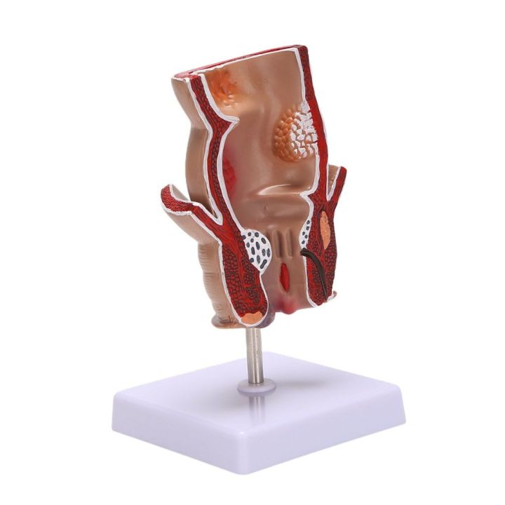 Human Anorectal Anatomical Model Rectum Lesion Hemorrhoids Anatomy ...