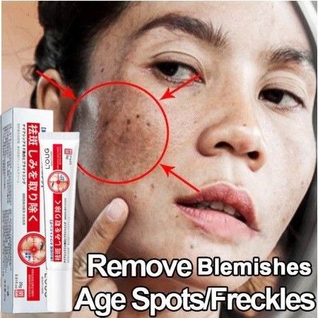 Effective Anti-freckle Cream Whitening Cream Removes Freckles Melasma ...